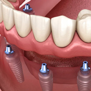 All On Four Implant Treatment - DB Dental Care - Website