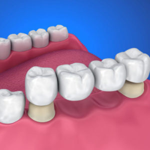 Dental Bridges - DB Dental Care - Website