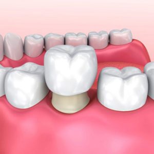 Dental Crowns - DB Dental Care